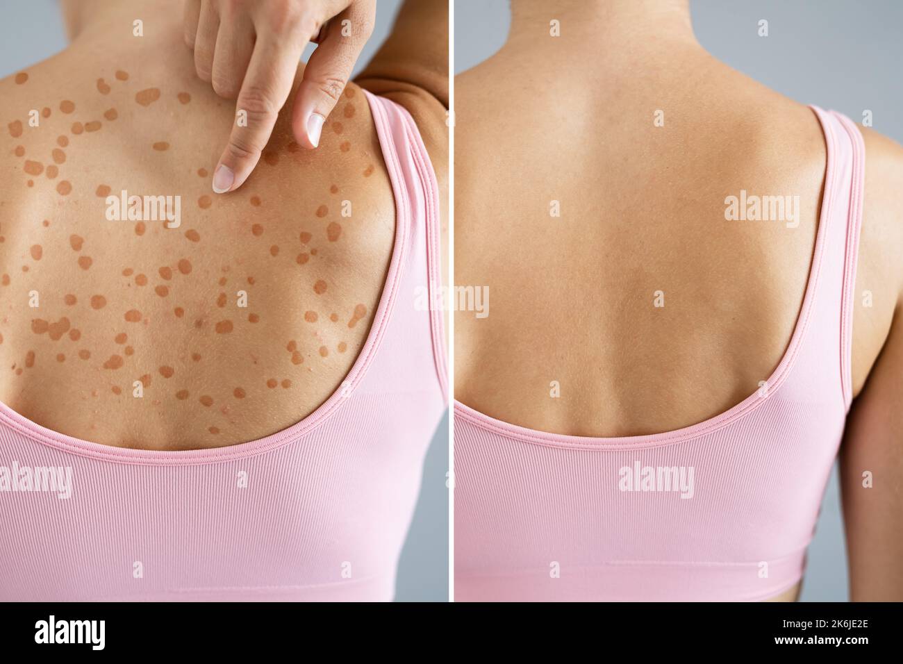 Psoriasis Disease Treatment Before After. Dermatology Skin Rash Stock ...