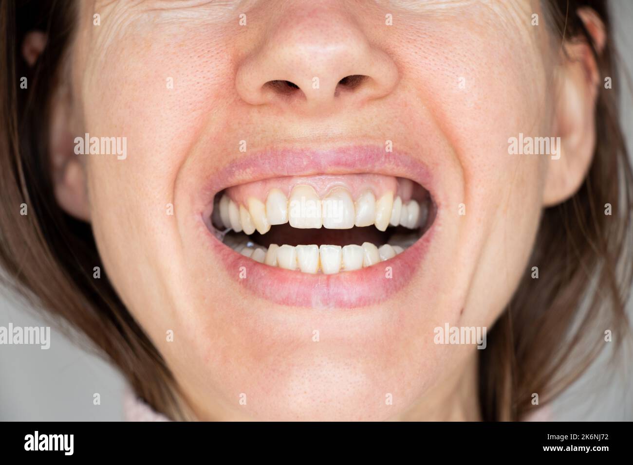 Girl with open mouth, female teeth with crowns and metal ceramics ...