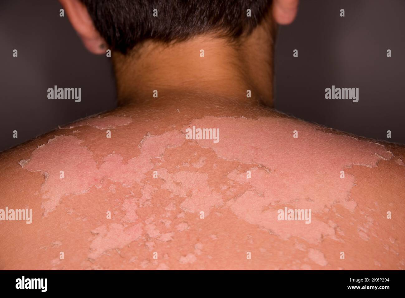 The delicate skin of an 11-year-old child burned by the sun. Concept of ...