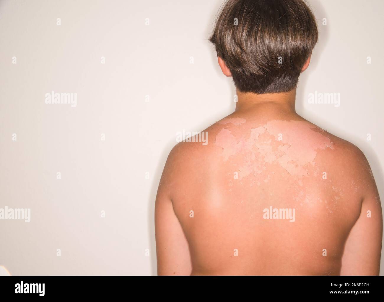 The delicate skin of an 11-year-old child burned by the sun. Concept of ...