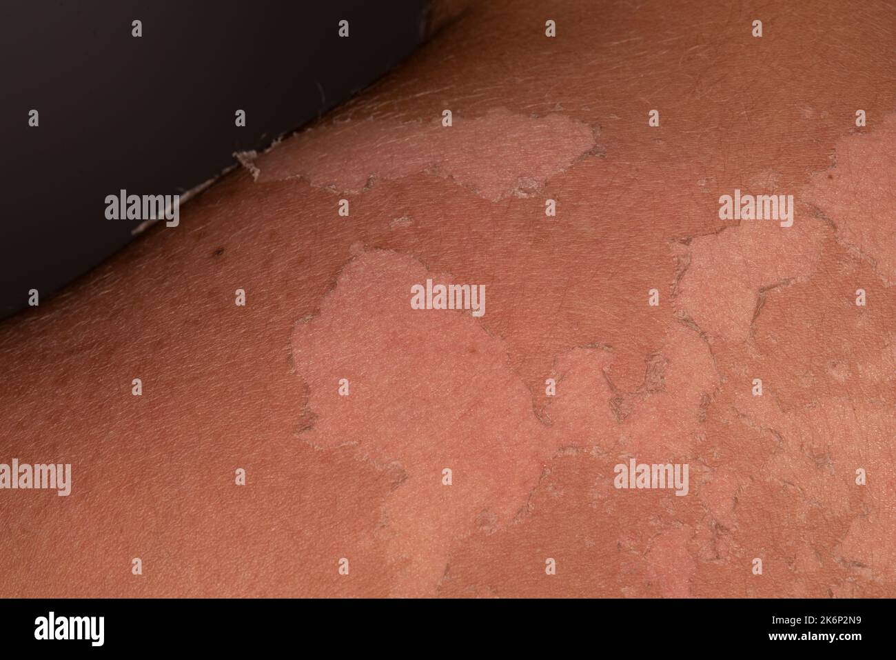 The delicate skin of an 11-year-old child burned by the sun. Concept of ...