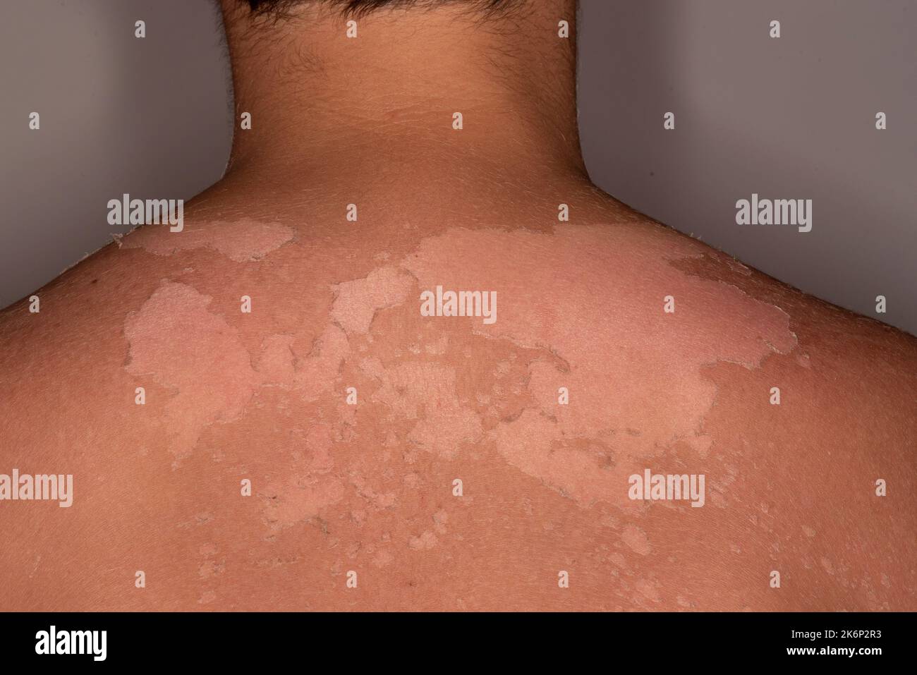 The delicate skin of an 11-year-old child burned by the sun. Concept of ...