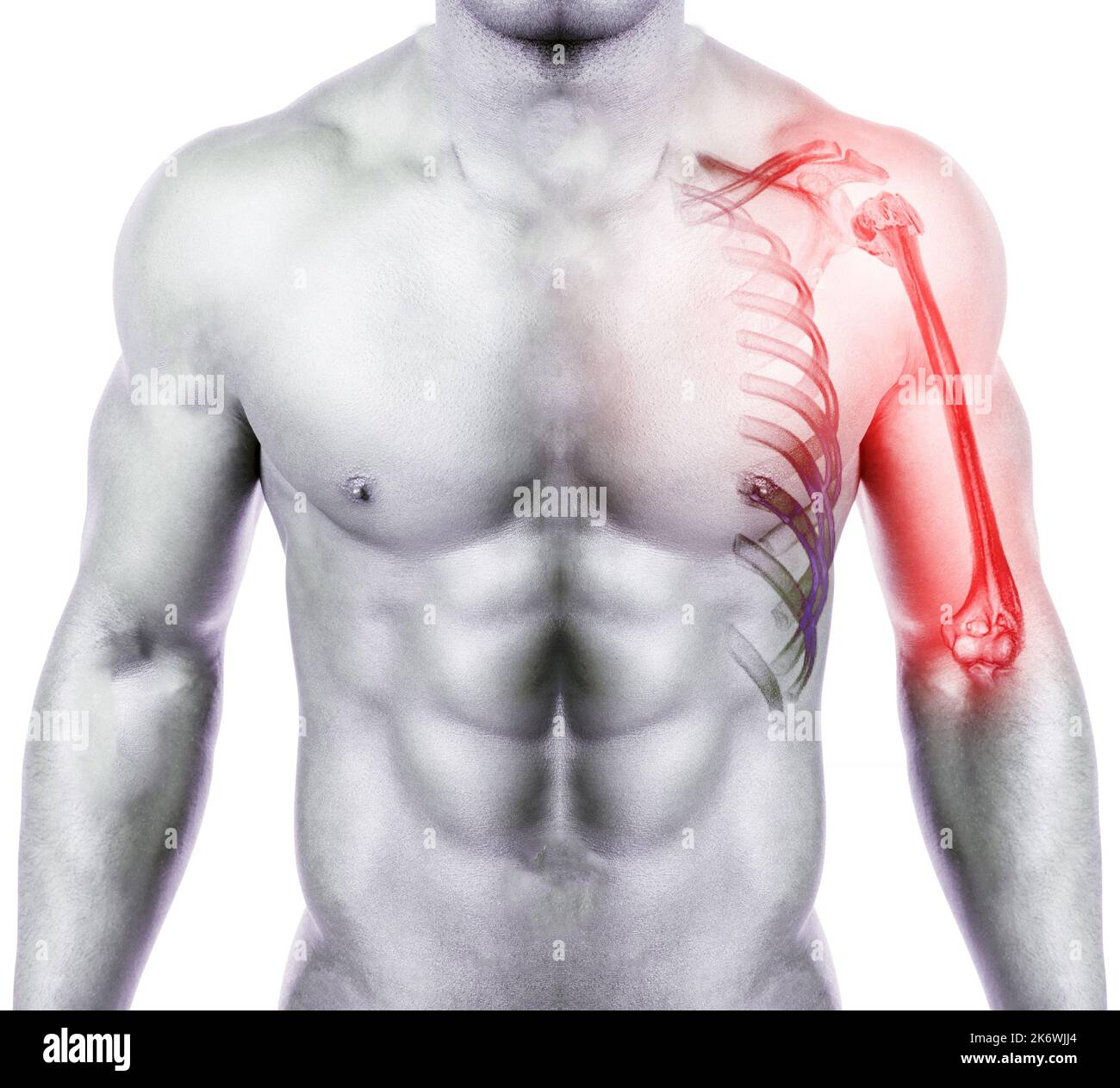 Fusion image of human and CT san humerus 3D rendering in case fracture ...