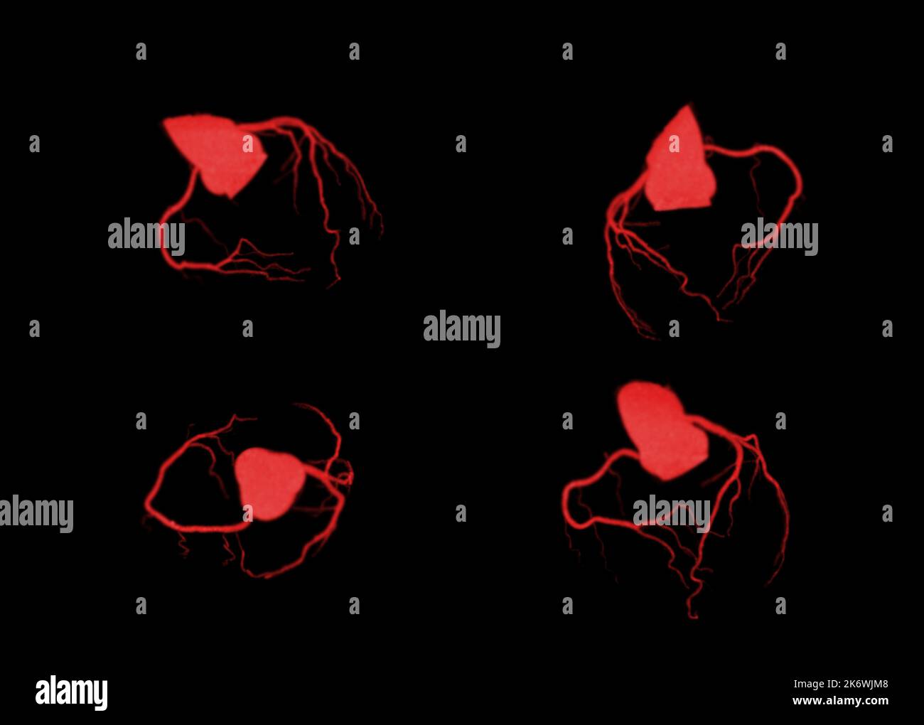 Collection of CT Cardiac 3D or CTA coronary artery for Check up ...