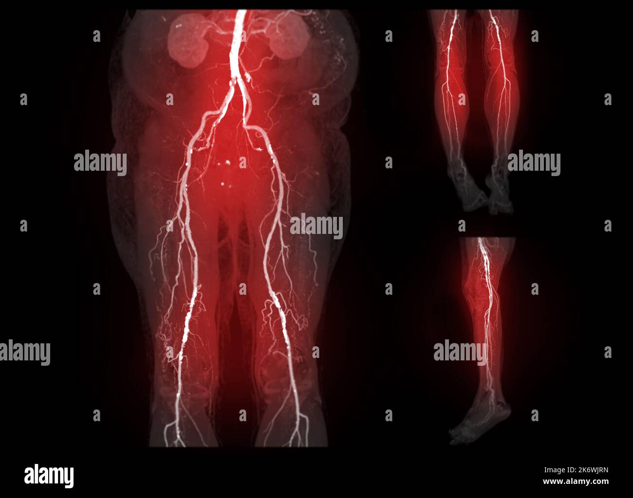 Chronic peripheral arterial disease hi-res stock photography and images ...