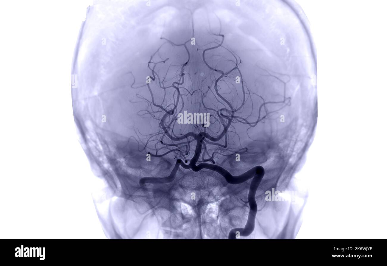 Cerebral angiography image from Fluoroscopy in intervention radiology ...