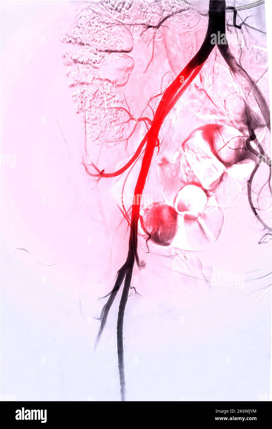 Femoral Angiogram of femoral artery showing femoral artery vessel ...