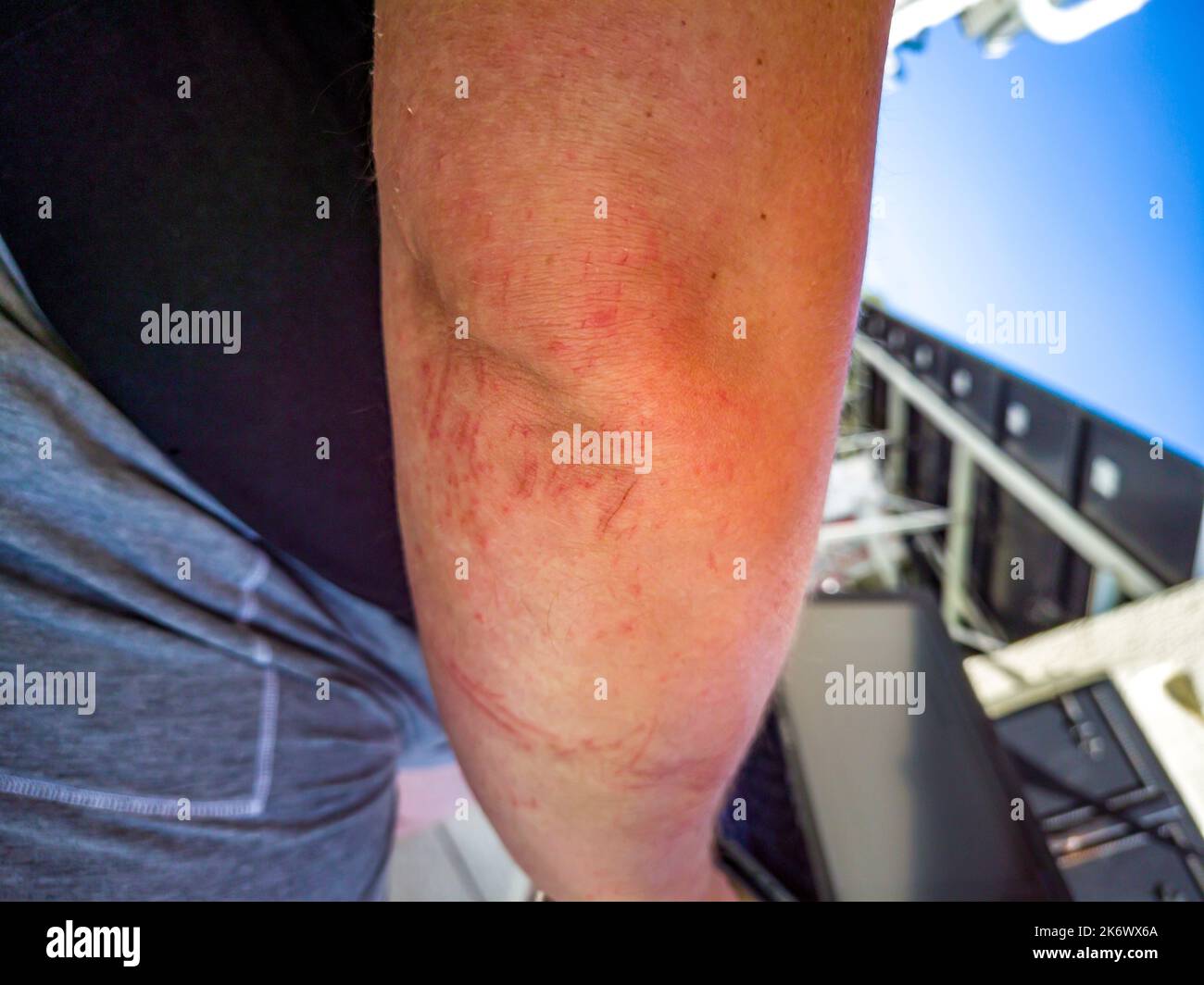 Scratchedd male arm after an accident Stock Photo - Alamy