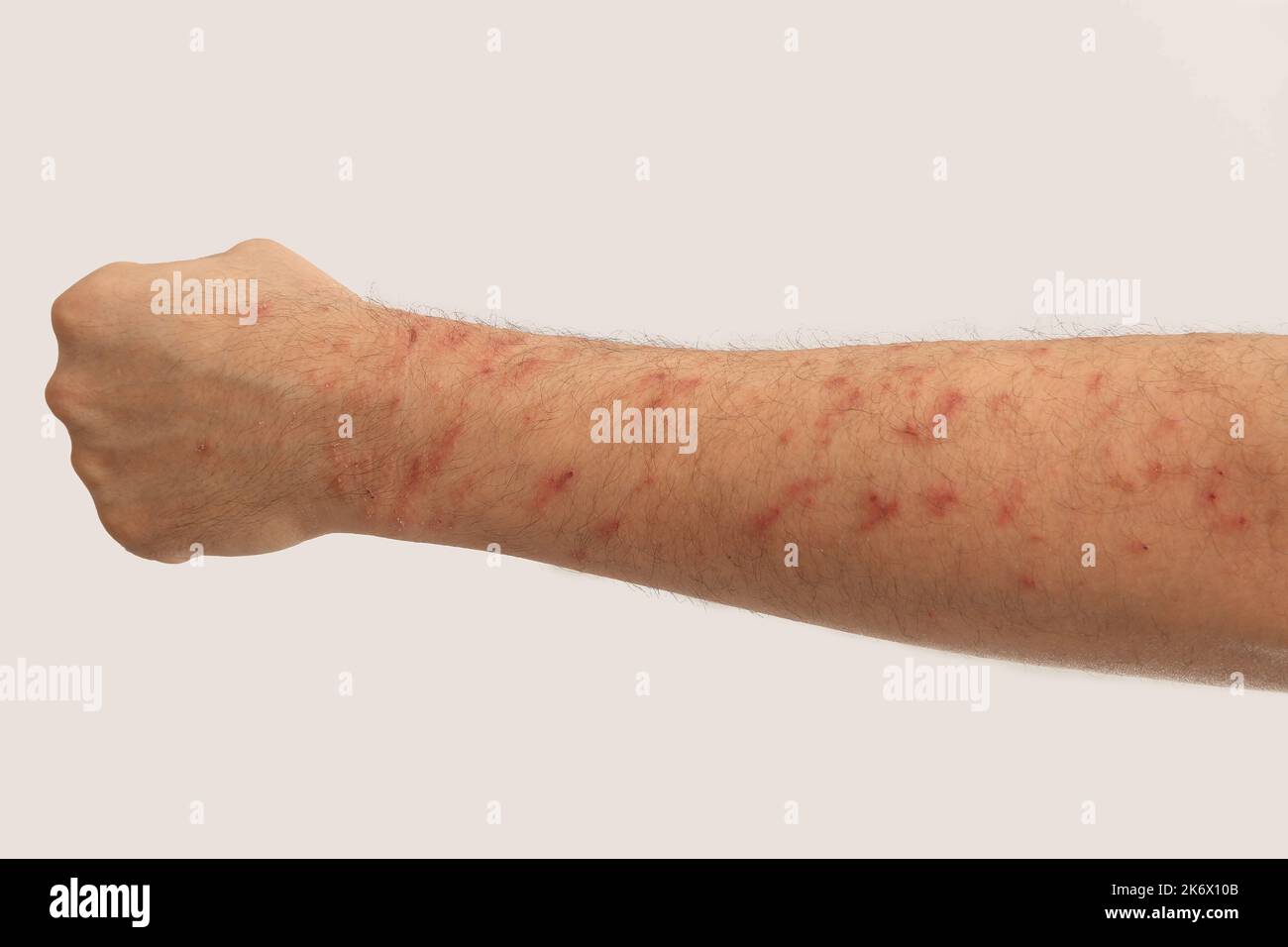 human arm scratched from elbow to hand Stock Photo - Alamy