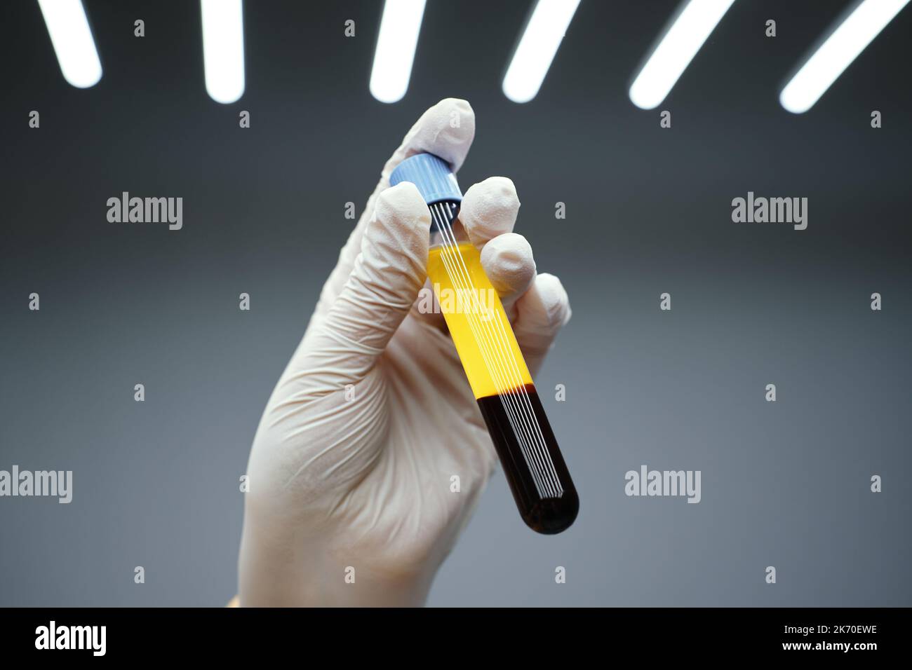 Injections of blood plasma in the face and head Stock Photo - Alamy