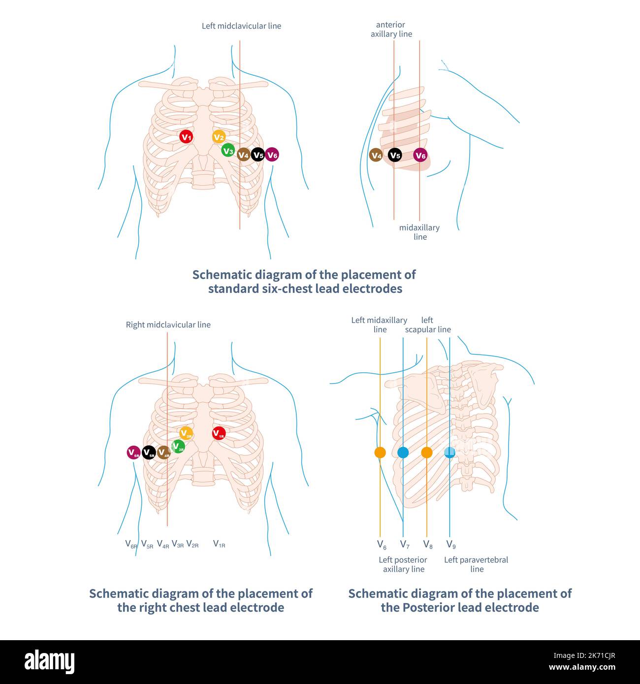 The chest electrode of ECG includes conventional chest lead, posterior ...
