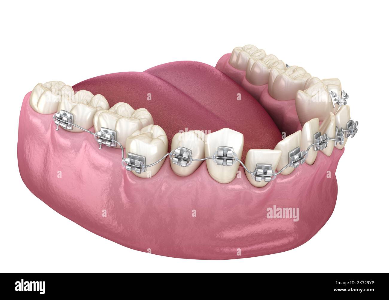 Abnormal teeth position and Clear braces tretament. Medically accurate ...