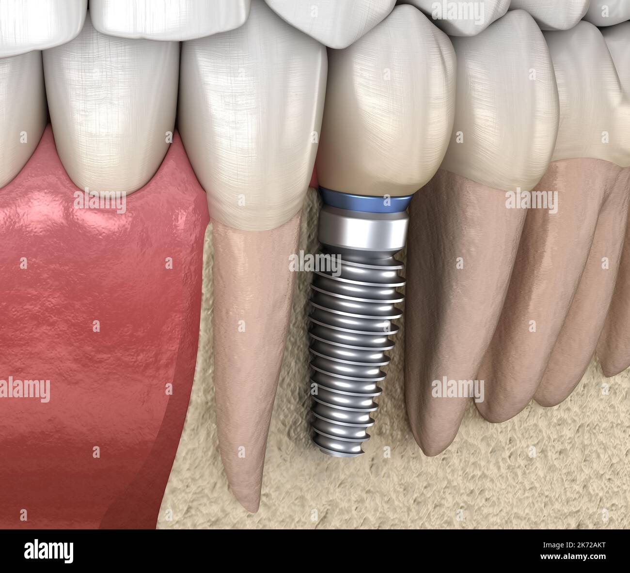 Premolar tooth recovery with implant. Medically accurate 3D ...