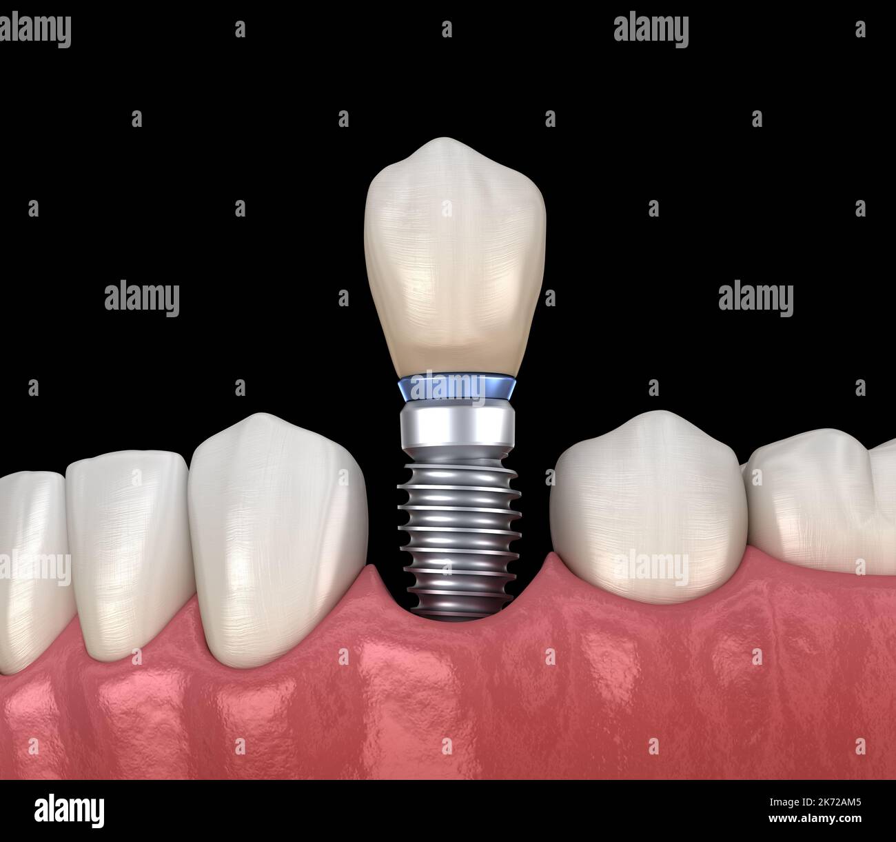 Premolar tooth recovery with implant. Medically accurate 3D ...