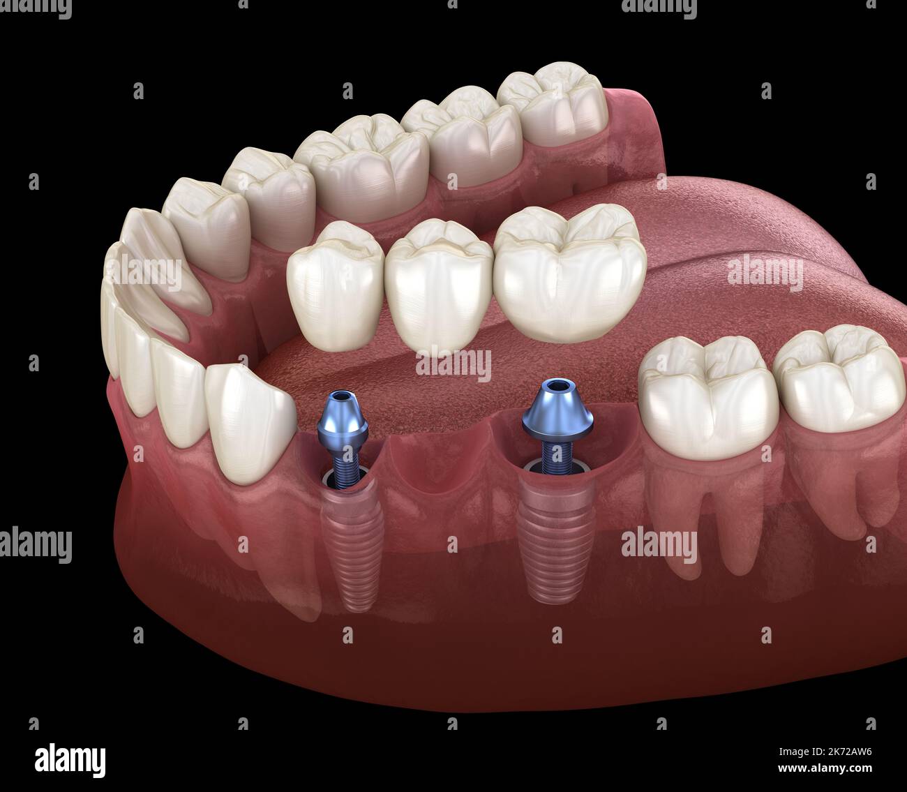 Dental bridge supported by implants. Medically accurate 3D illustration ...