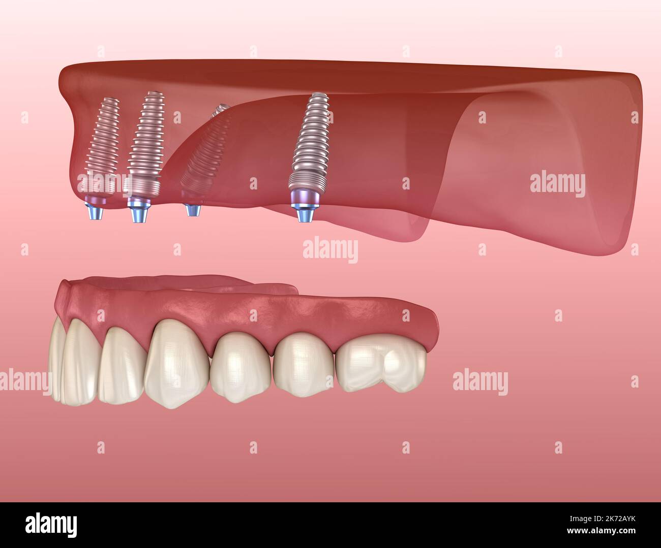 Maxillary prosthesis with gum All on 4 system supported by implants ...