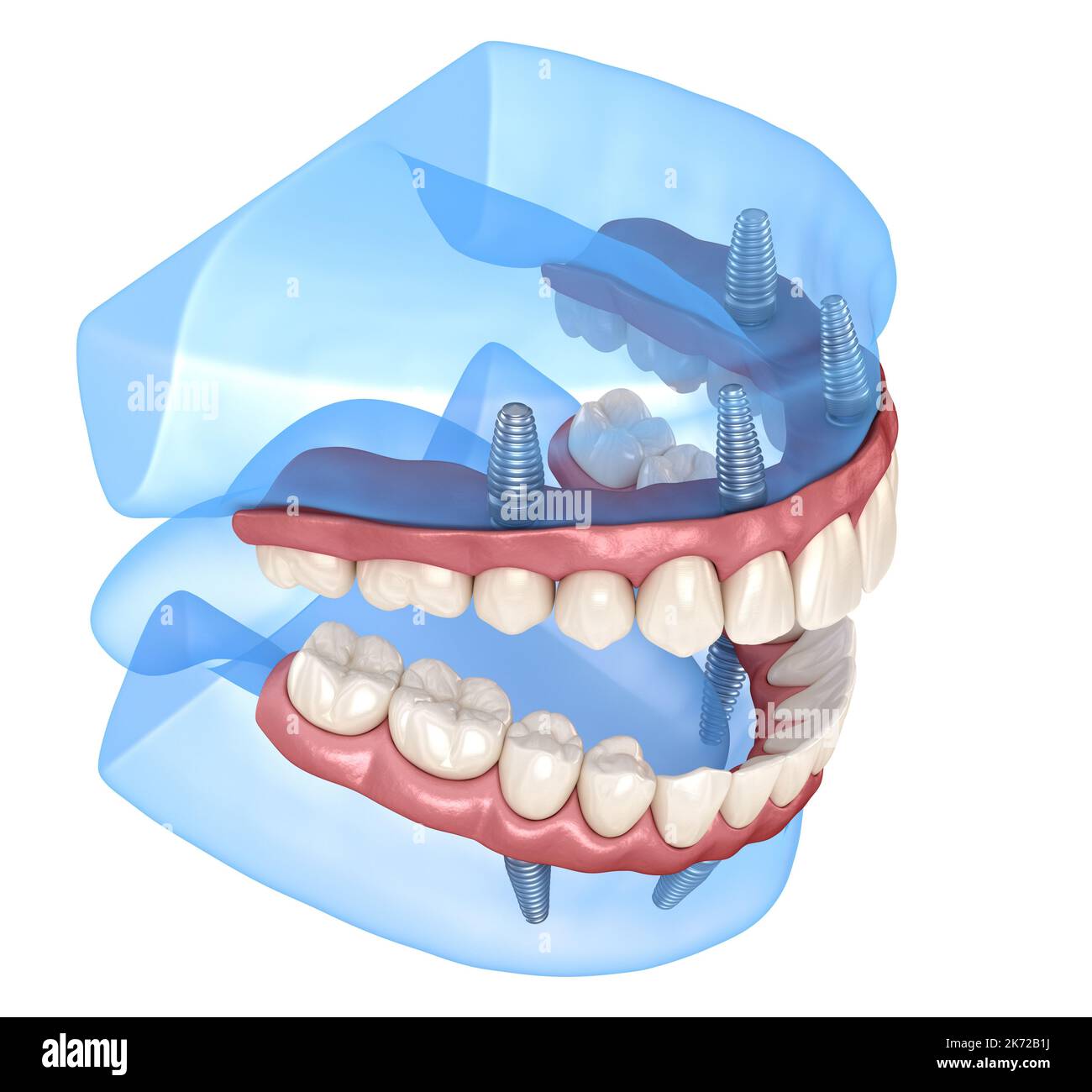 Maxillary and Mandibular prosthesis with gum All on 4 system supported ...