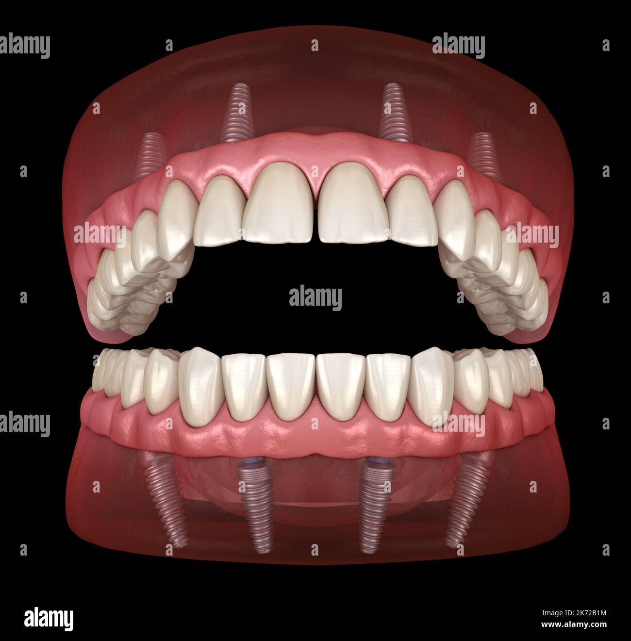 Maxillary and Mandibular prosthesis with gum All on 4 system supported ...