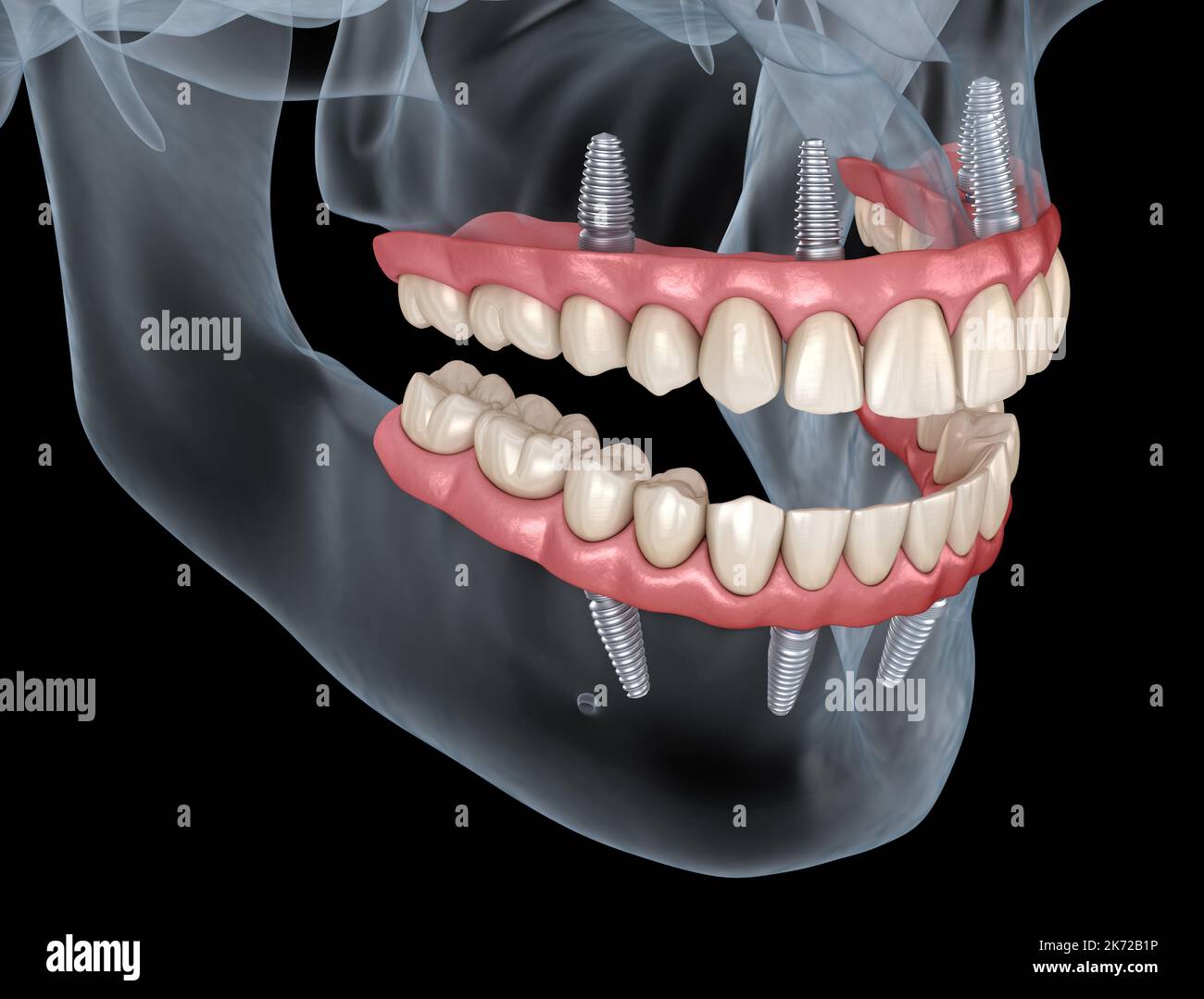 Maxillary and Mandibular prosthesis with gum All on 4 system supported ...