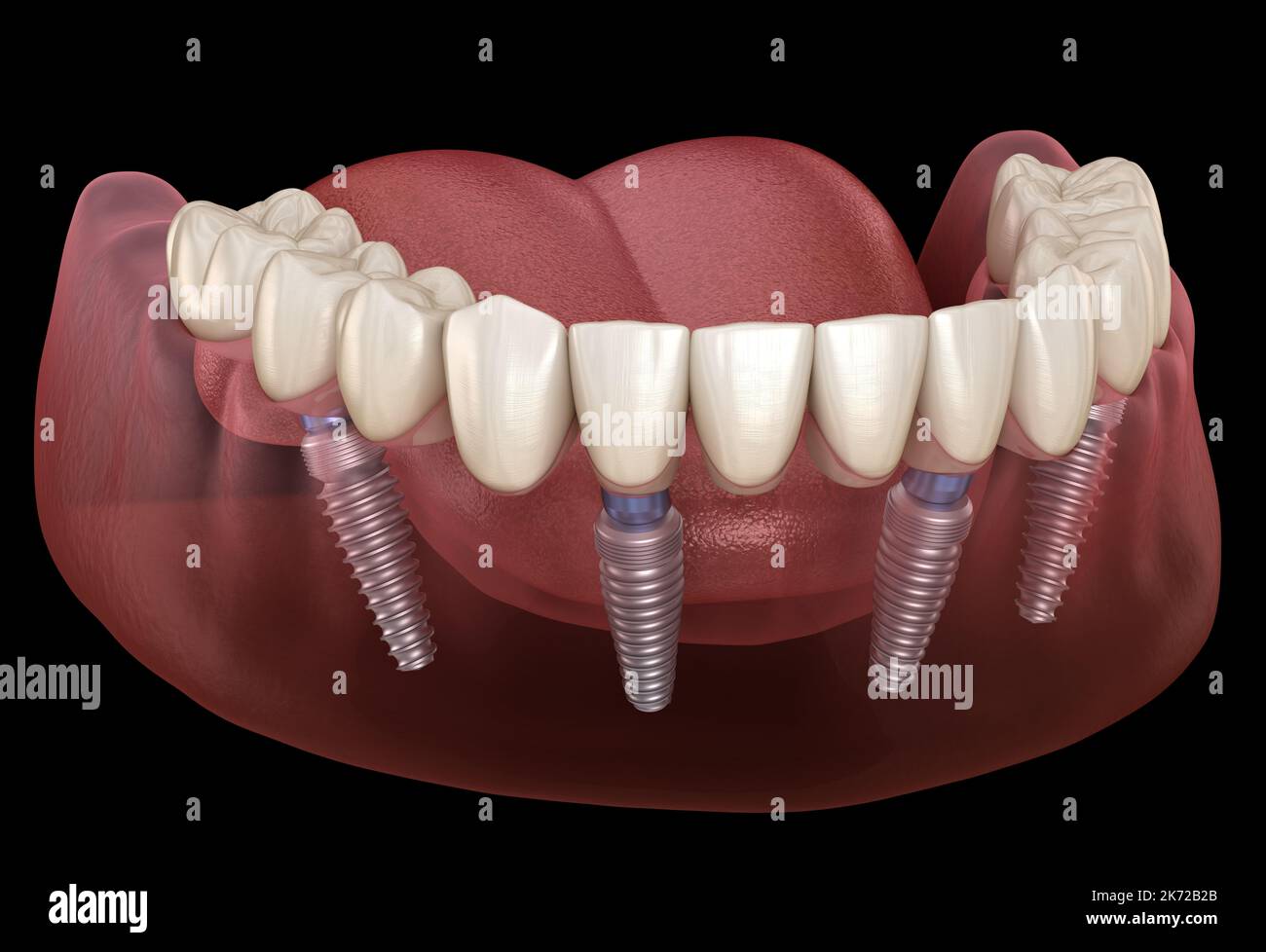 Mandibular prosthesis All on 4 system supported by implants. Medically ...