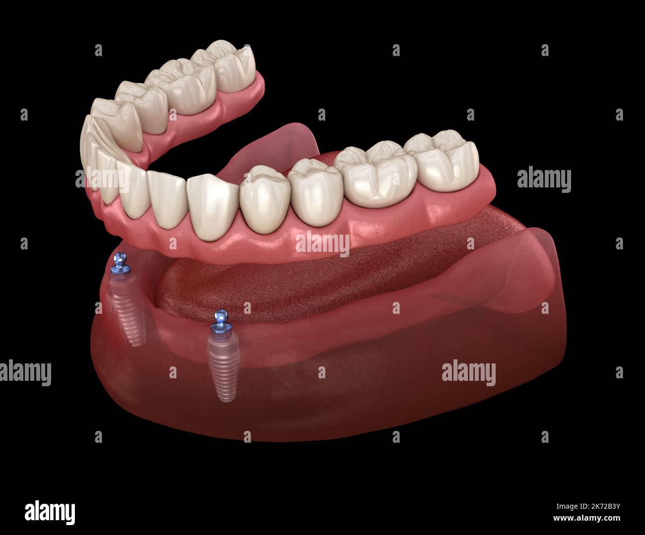Mandibular removable prosthesis All on 2 system supported by implants ...
