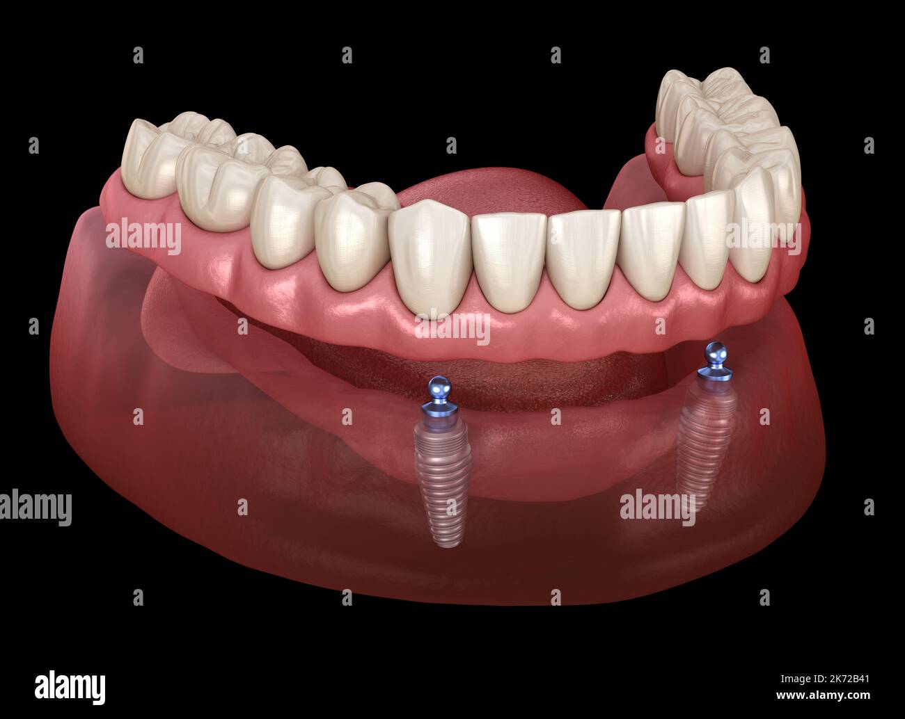 Mandibular removable prosthesis All on 2 system supported by implants ...