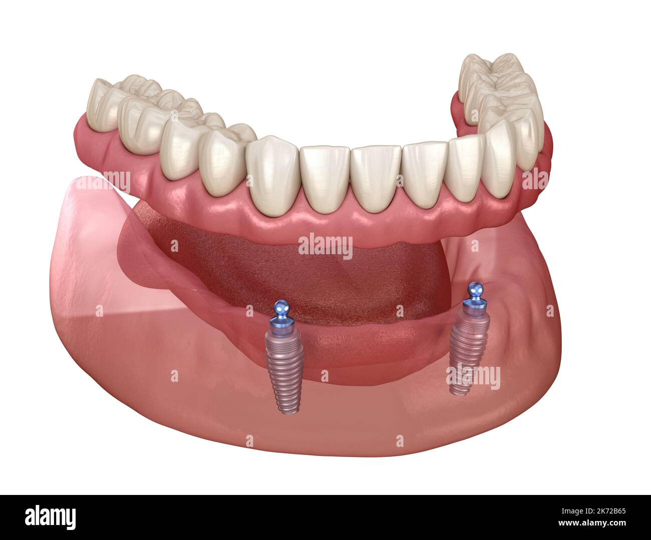 Mandibular removable prosthesis All on 2 system supported by implants ...