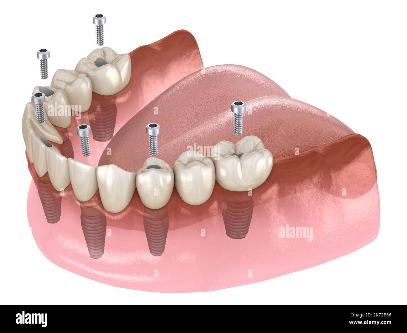 Mandibular prosthesis with gum All on 6 system supported by implants ...