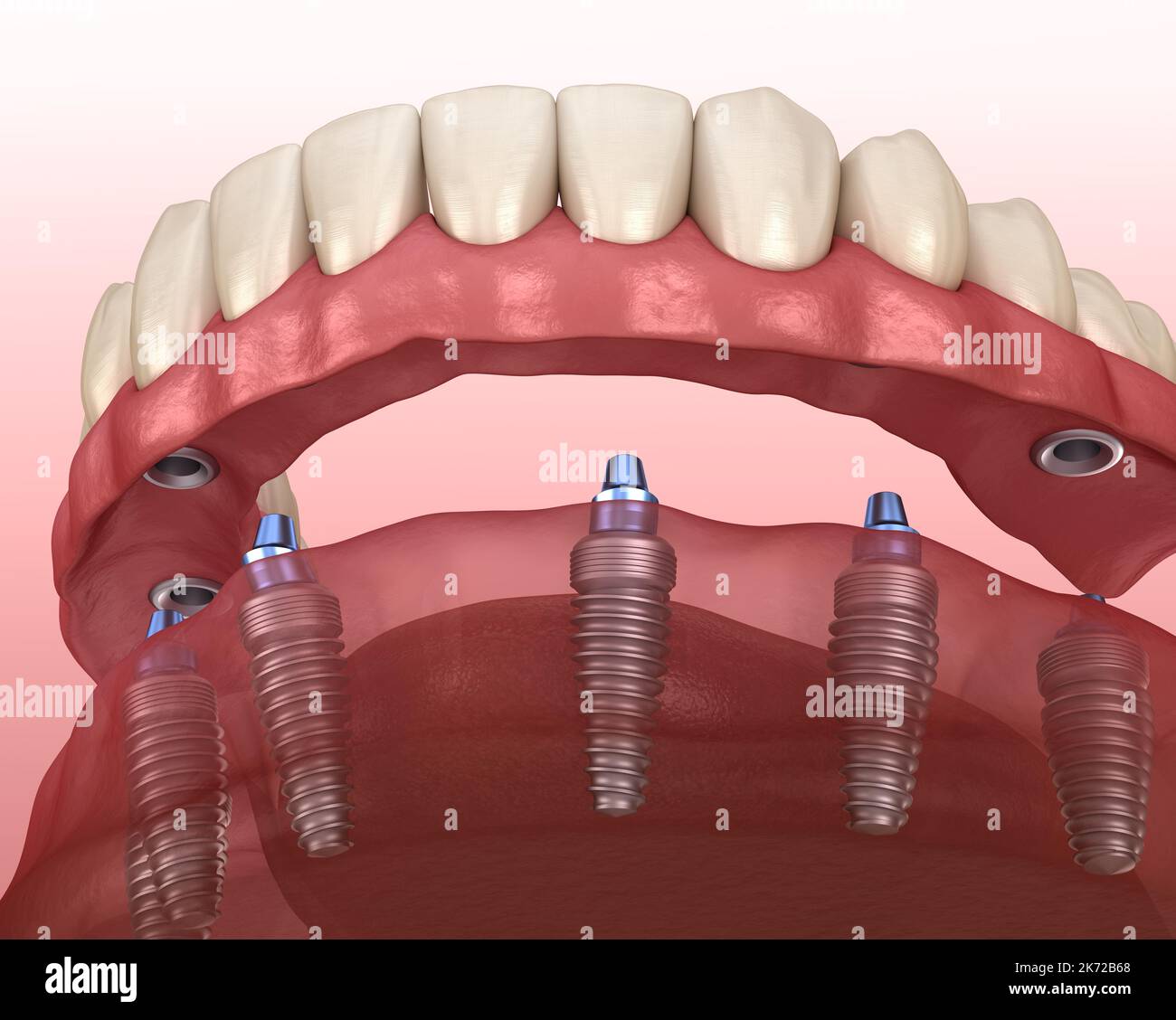 Mandibular prosthesis with gum All on 6 system supported by implants ...