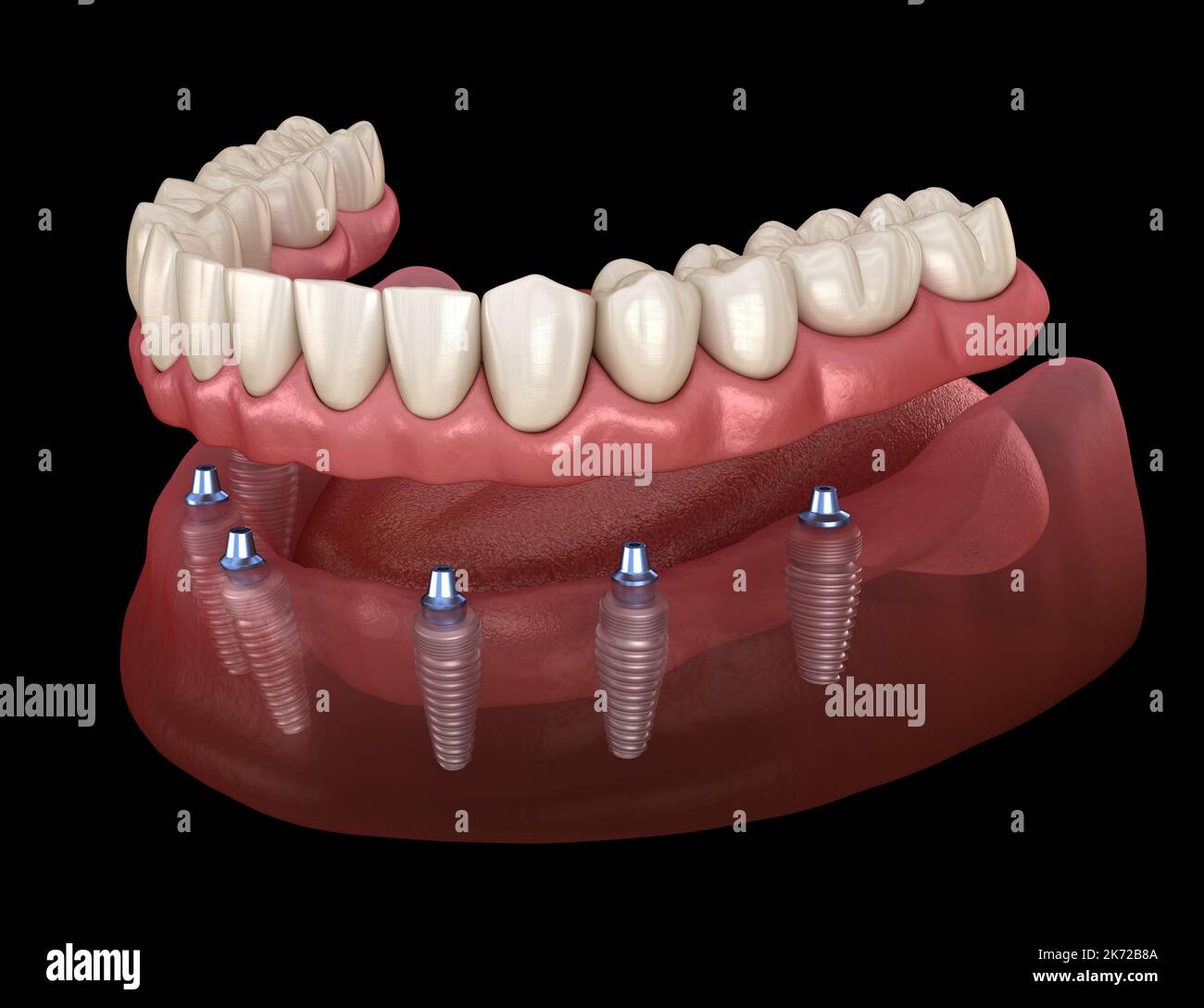 Mandibular prosthesis All on 6 system supported by implants. Medically ...
