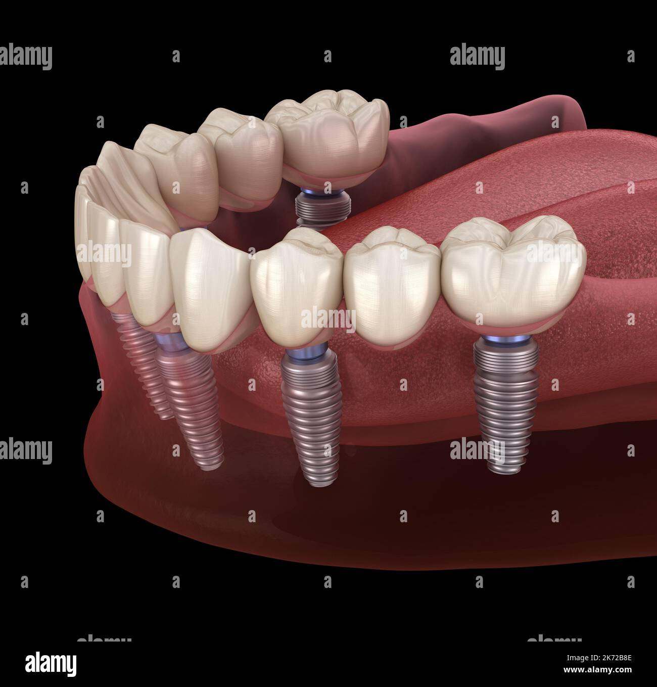 Mandibular prosthesis All on 6 system supported by implants. Medically ...