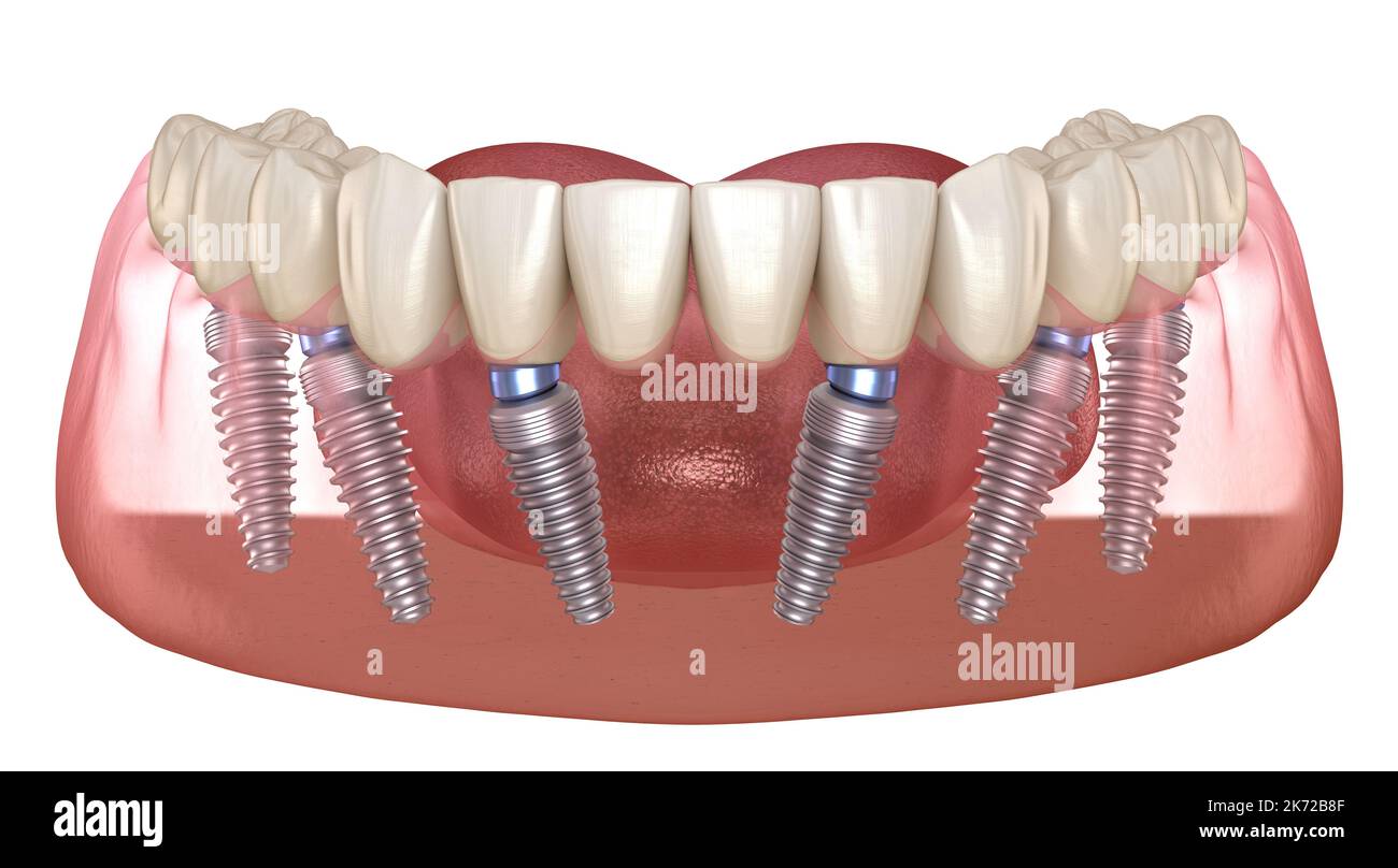 Mandibular prosthesis All on 6 system supported by implants. Medically ...