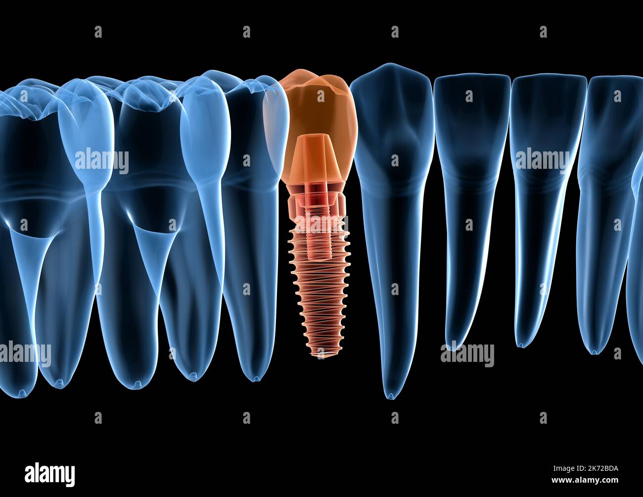 Teeth recovery with implant, x-ray view. Medically accurate 3D ...