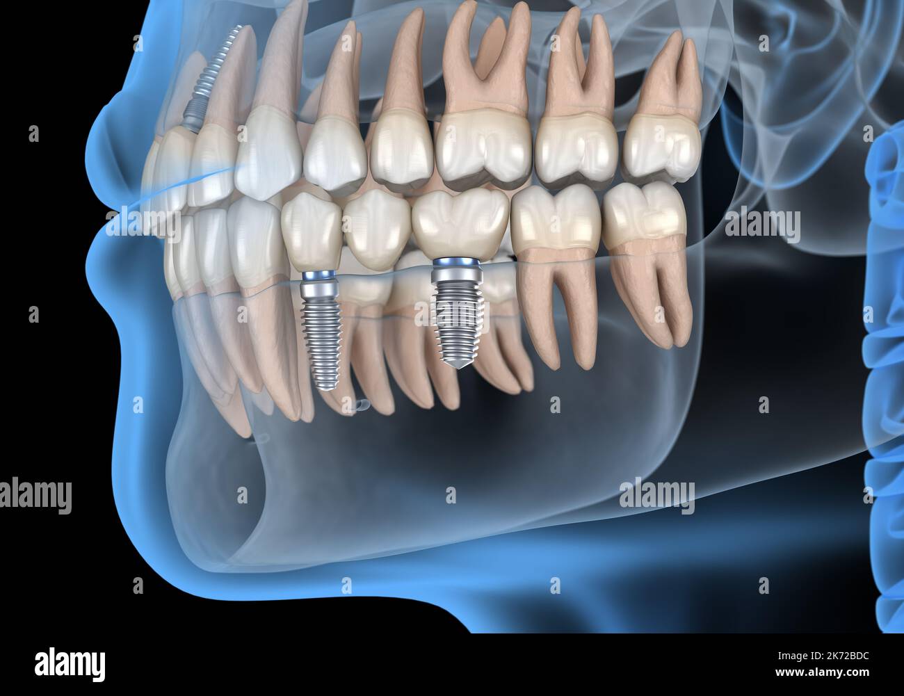 Teeth recovery with implant, x-ray view. Medically accurate 3D ...