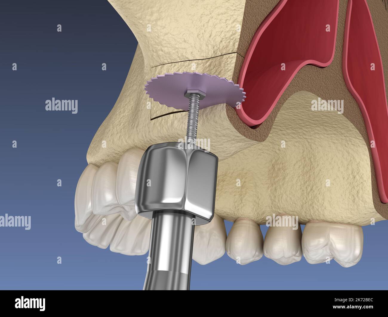 Sinus Lift Surgery - Creating side access to the Sinus. 3D illustration ...