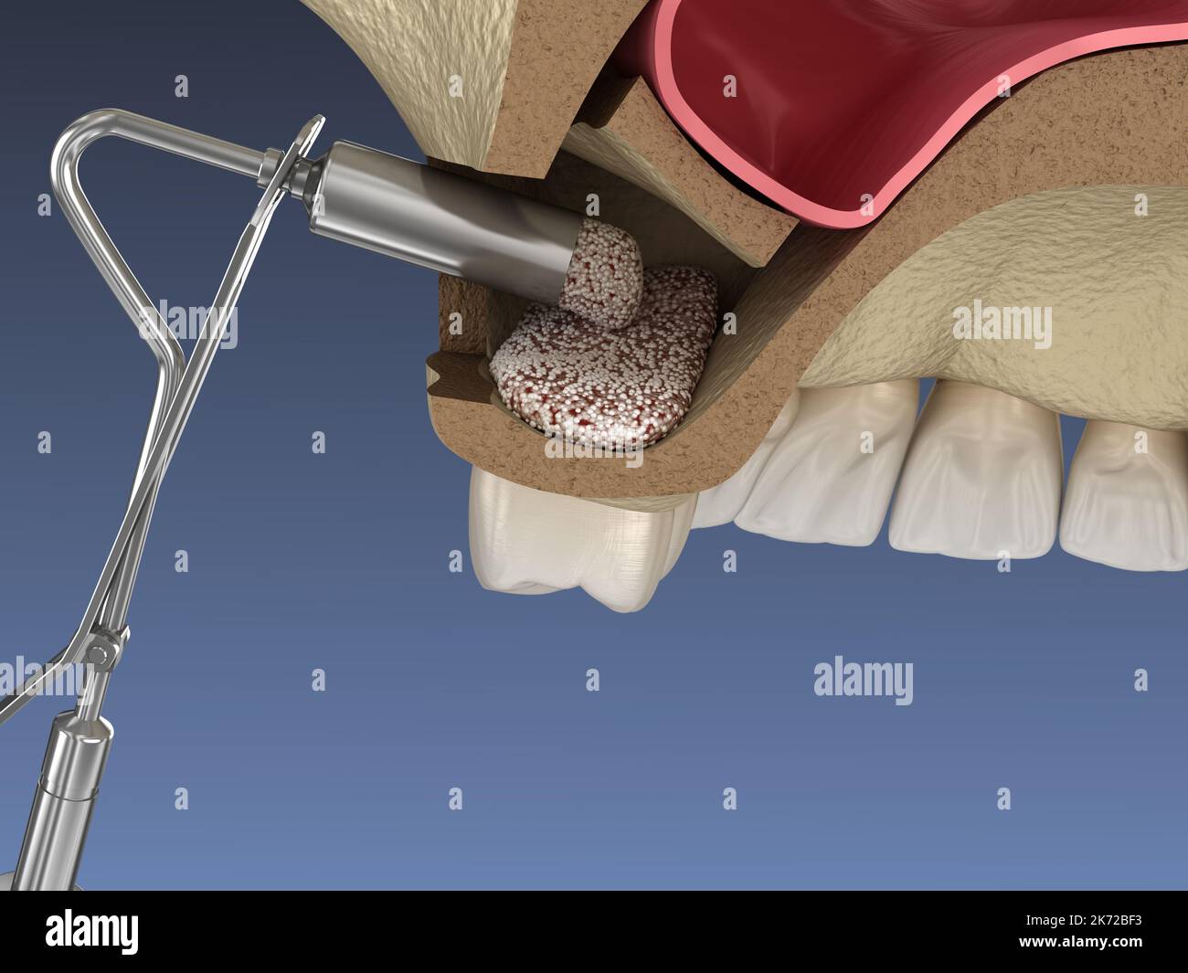 Sinus Lift Surgery - Adding new bone. 3D illustration Stock Photo - Alamy
