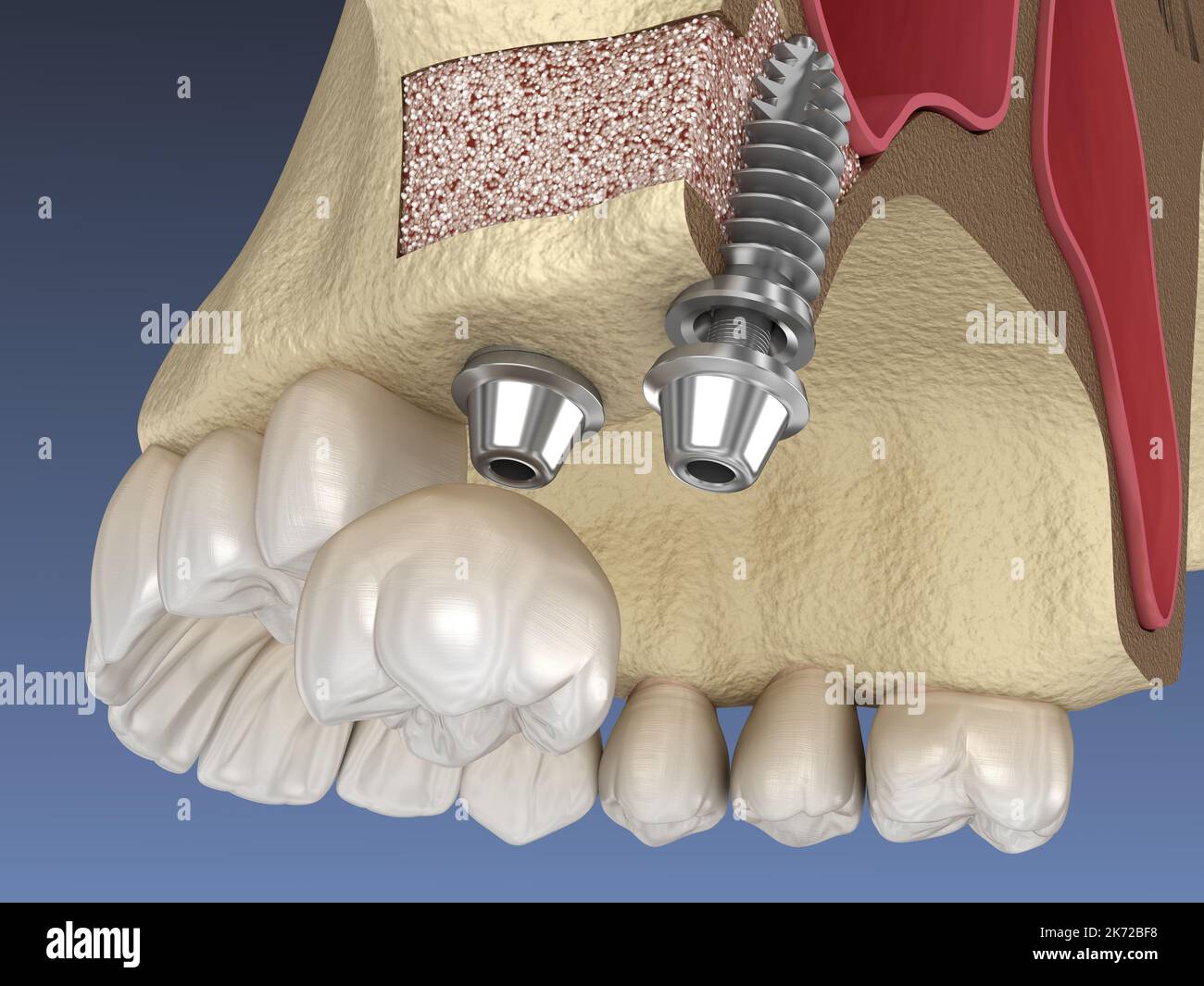 Sinus Lift Surgery - implant installation. 3D illustration Stock Photo ...