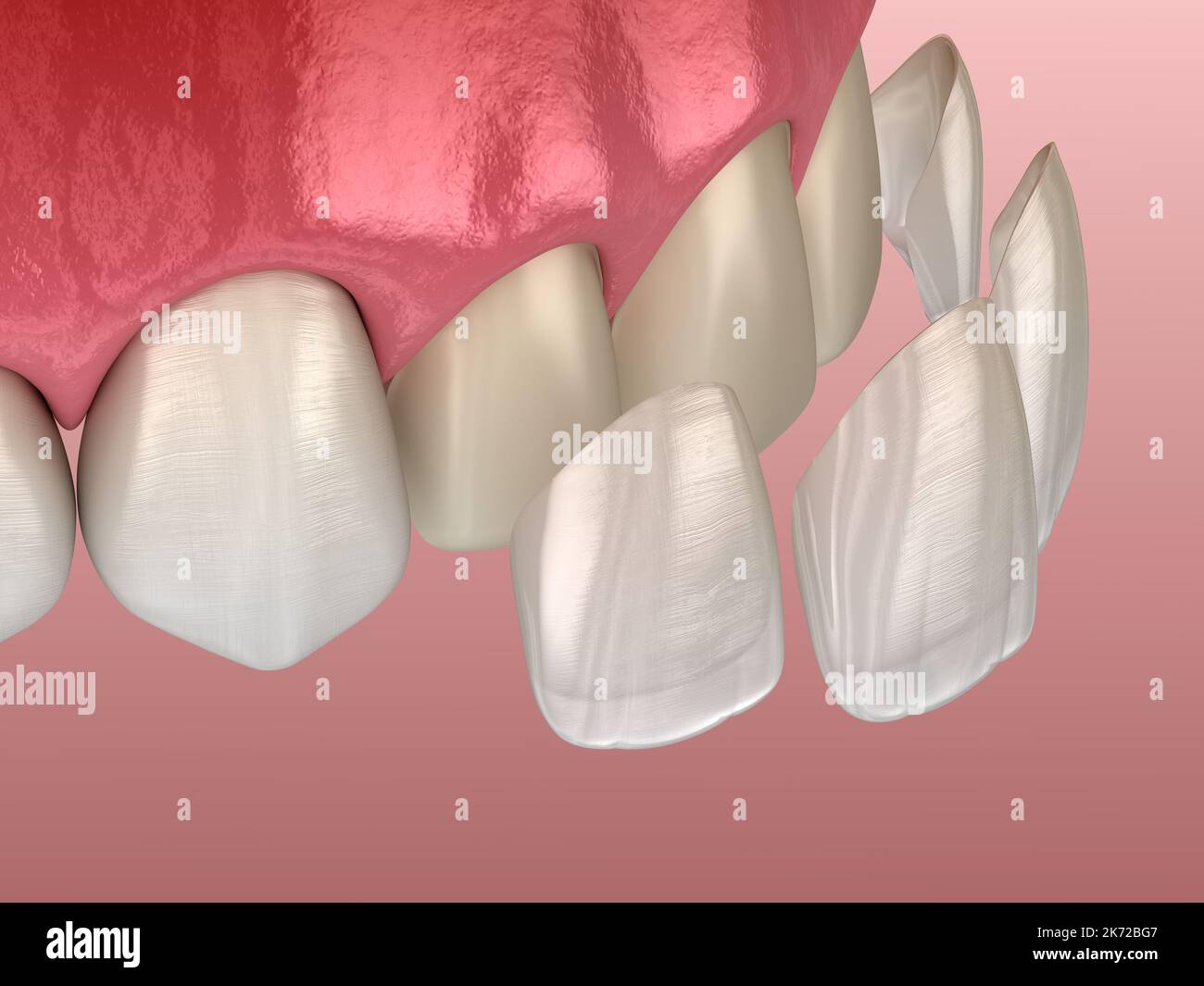 Veneer installation procedure over central incisor and lateral incisor ...