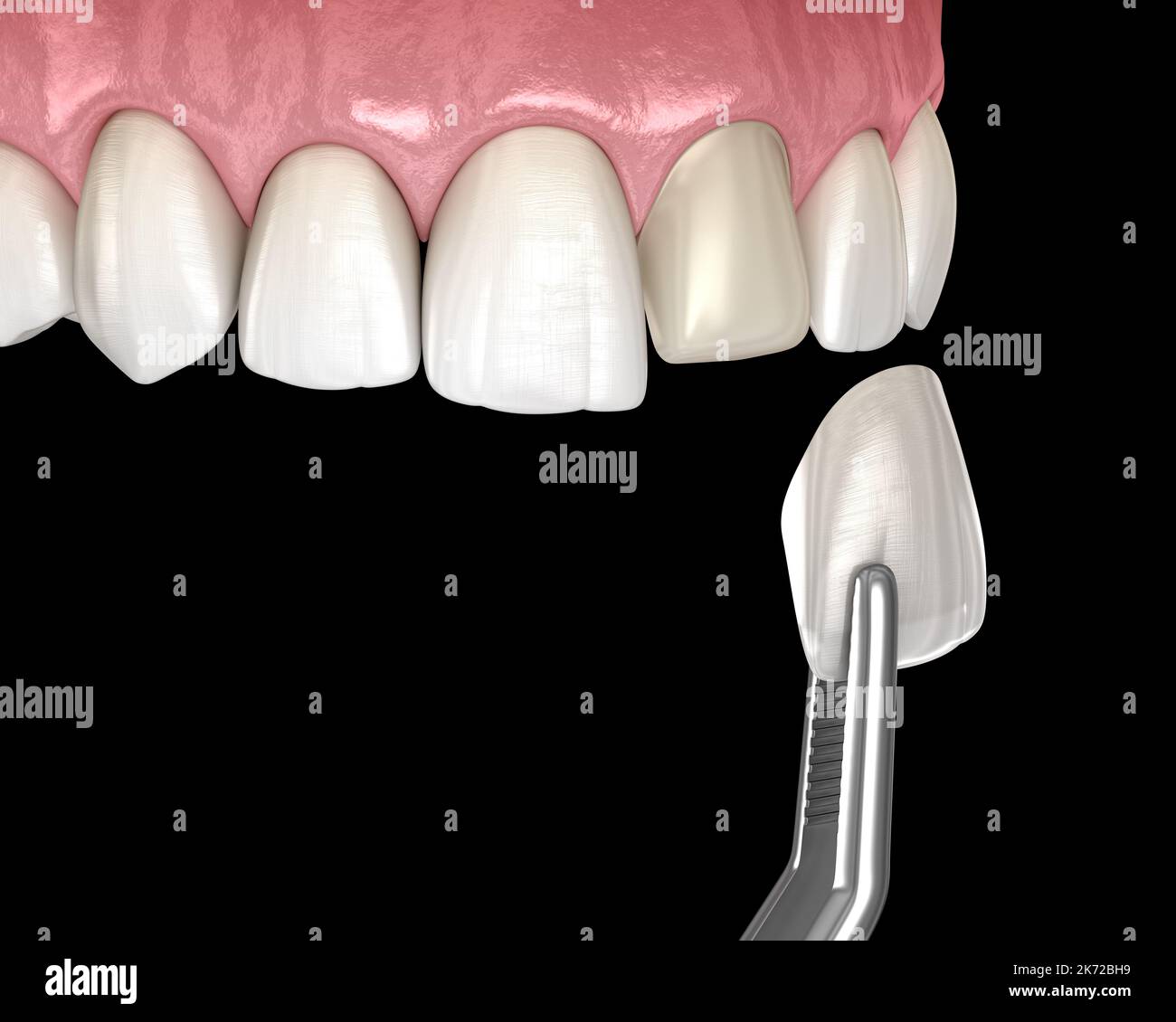 Veneer installation procedure over central incisor. Medically accurate ...