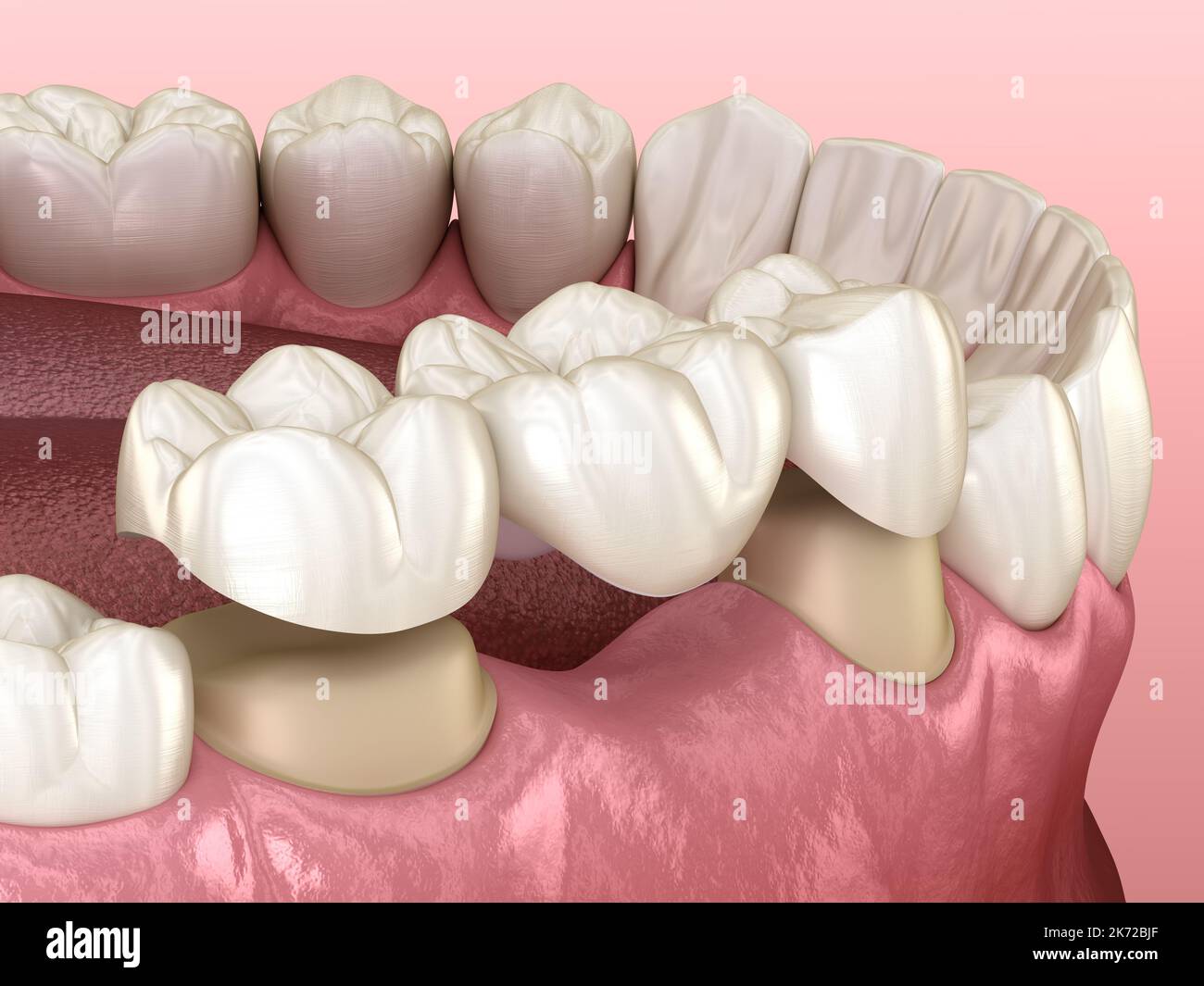 Dental bridge of 3 teeth over molar and premolar. Medically accurate 3D ...