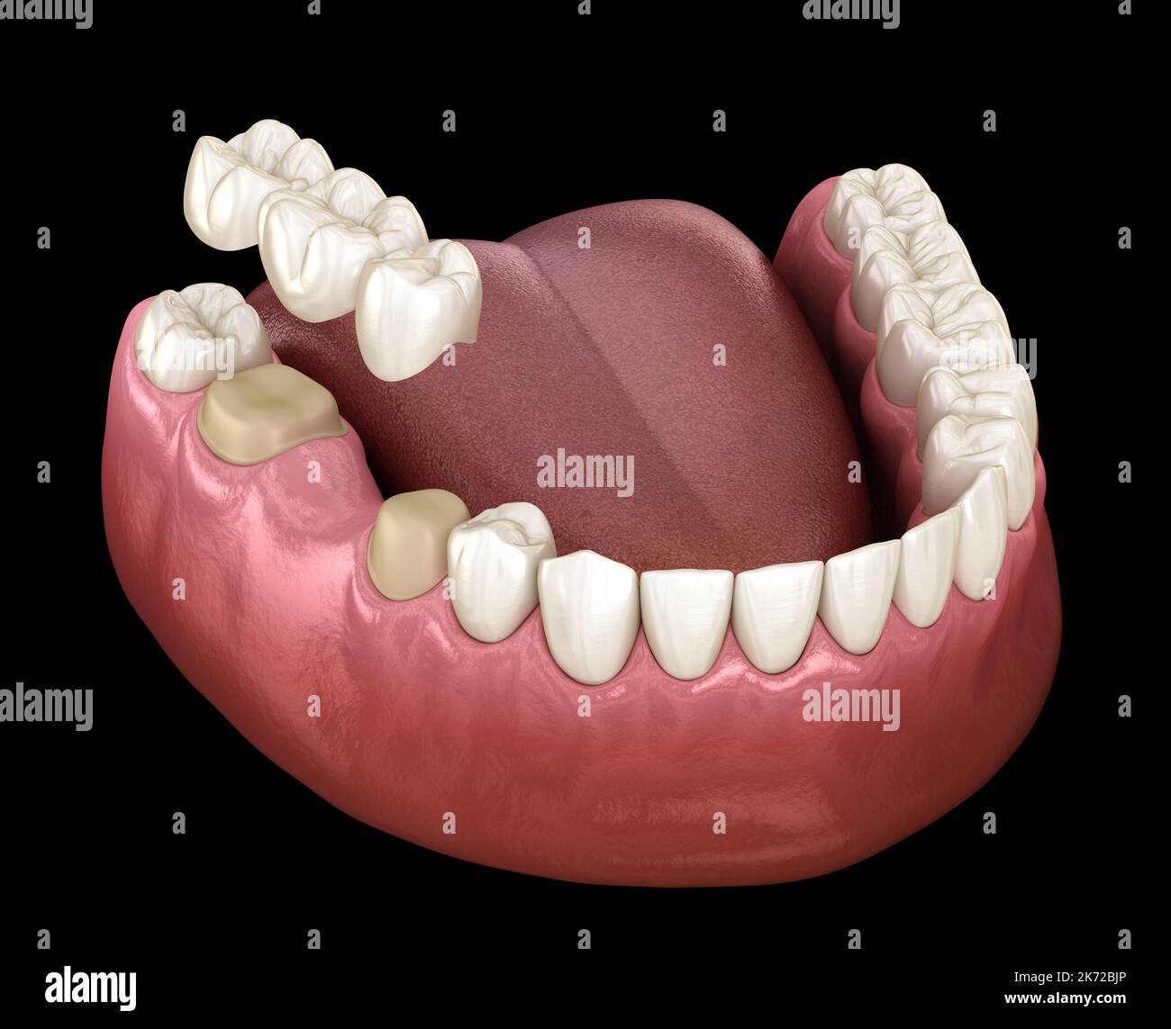 Dental bridge of 3 teeth over molar and premolar. Medically accurate 3D ...