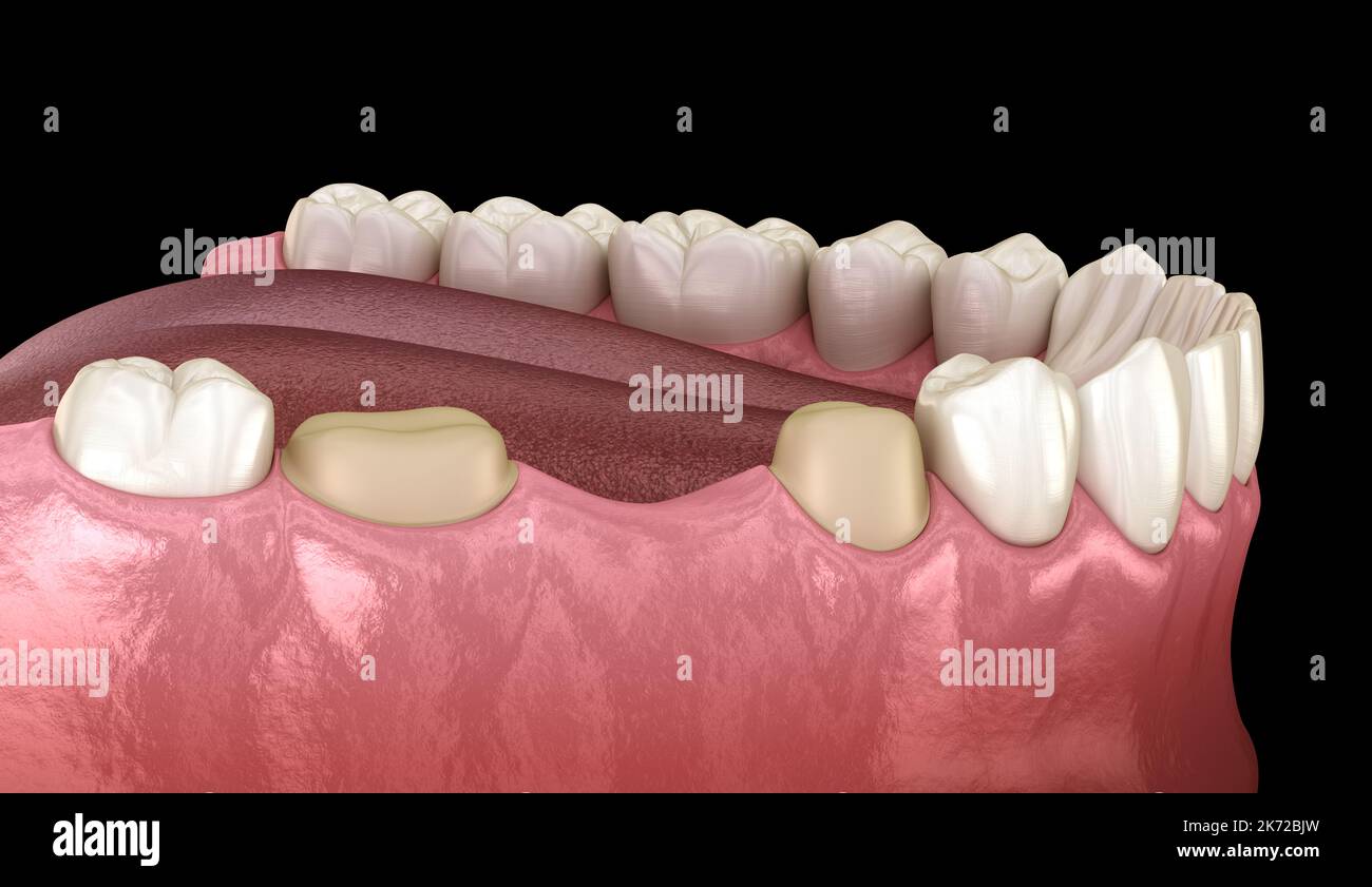 Preparated molar and premolar tooth for dental bridge placement ...