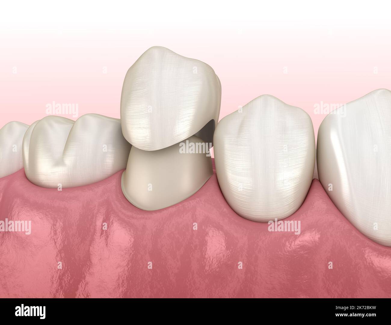 Preparated premolar tooth and dental crown placement. Medically ...