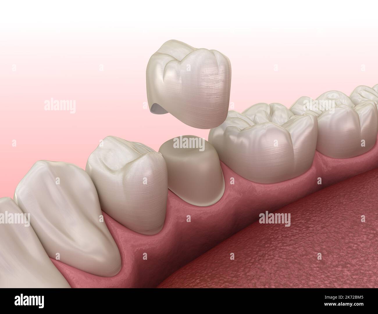 Preparated premolar tooth and dental crown placement. Medically ...