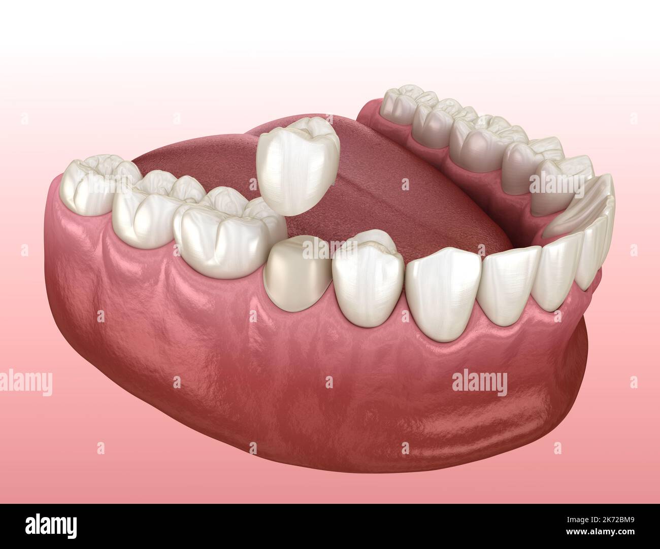 Preparated premolar tooth and dental crown placement. Medically ...