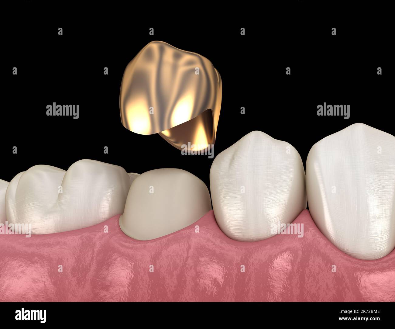 Golden crown premolar tooth assembly process. Medically accurate 3D ...