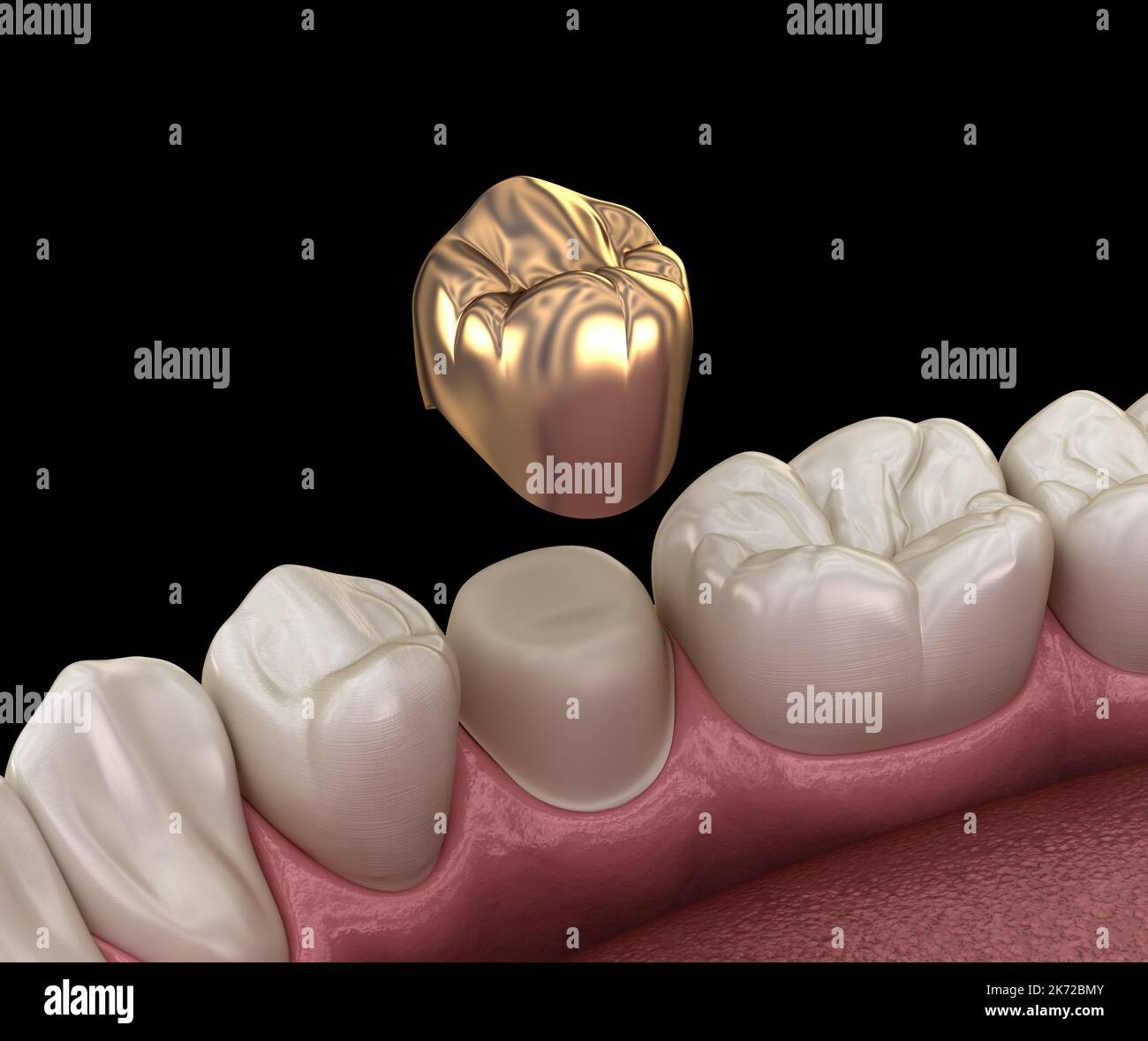Golden crown premolar tooth assembly process. Medically accurate 3D ...