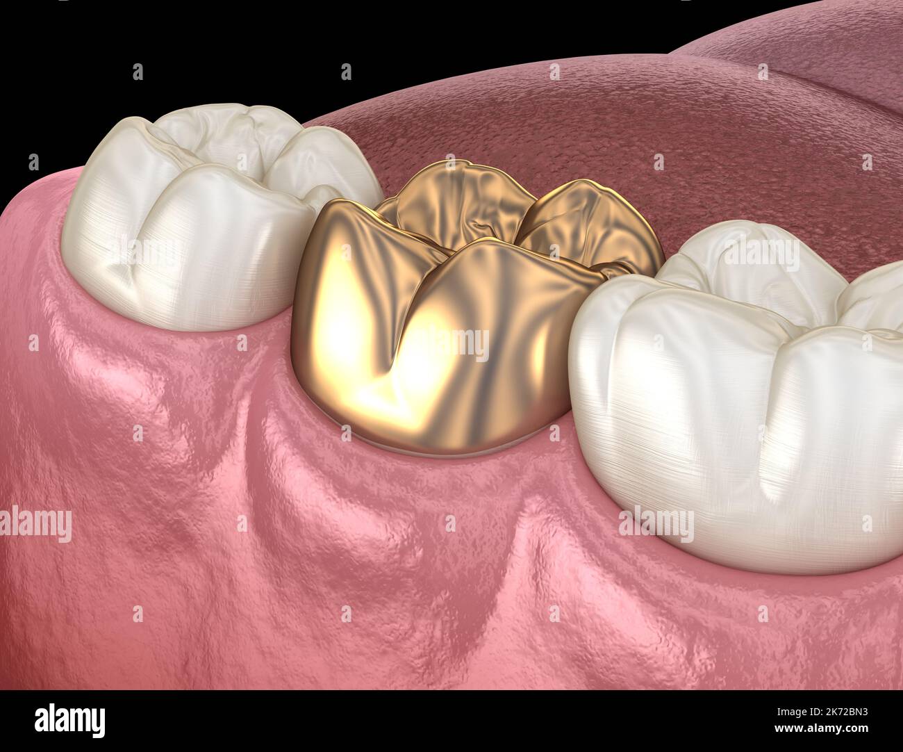 Golden crown molar tooth assembly process. Medically accurate 3D ...