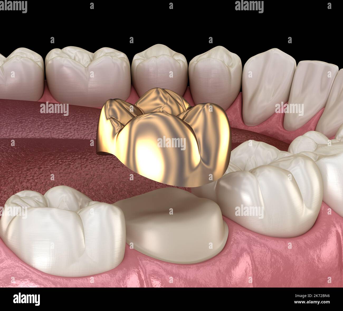Golden crown molar tooth assembly process. Medically accurate 3D ...