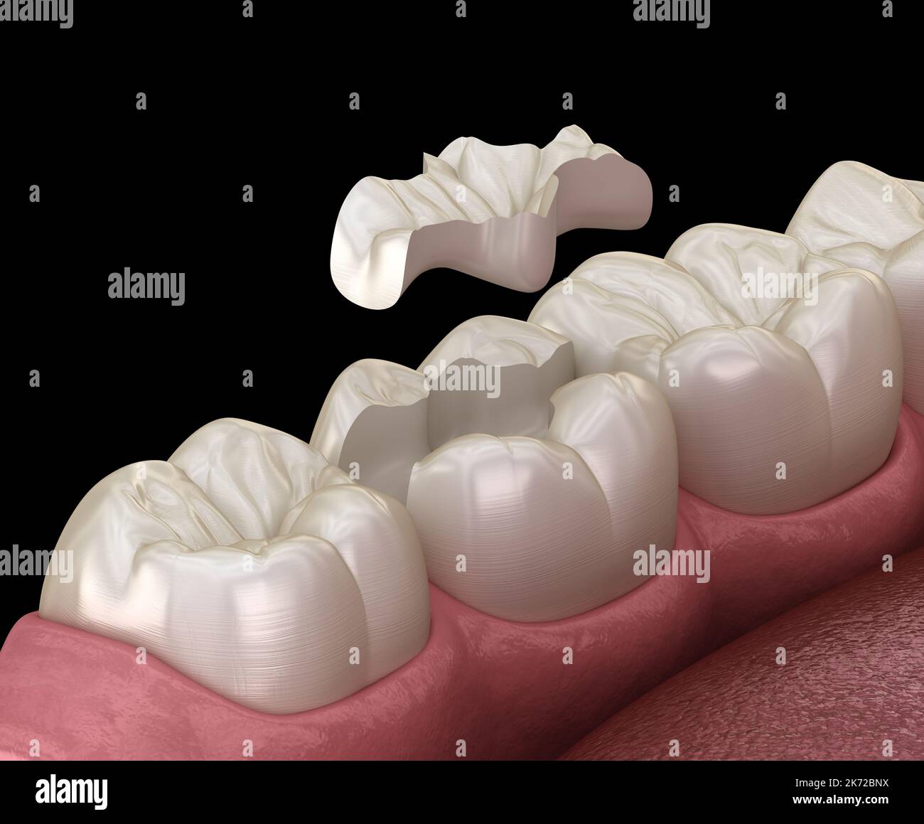 Inlay ceramic crown fixation over tooth. Medically accurate 3D ...